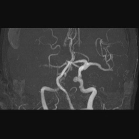 【頭部】TIPS症例48 MRA MIP像