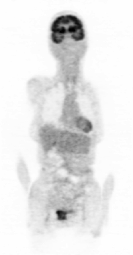 【頭部】TIPS症例55 PET MIP像