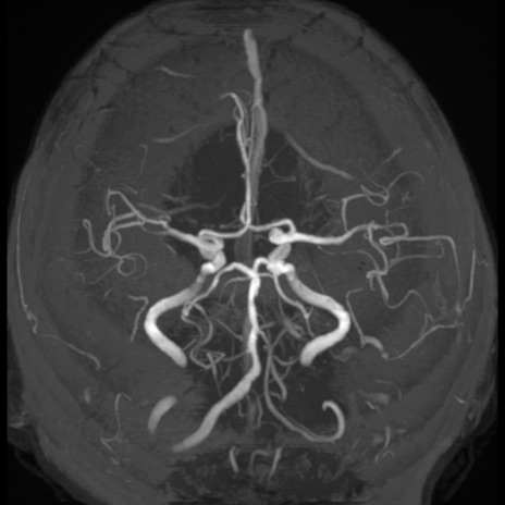 【頭部】症例59 MRI（MRA MIP像）4日後