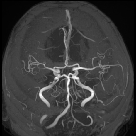 【頭部】症例59 MRI（MRA MIP像）4日後
