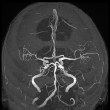 【頭部】症例59 MRI（MRA MIP像）4日後