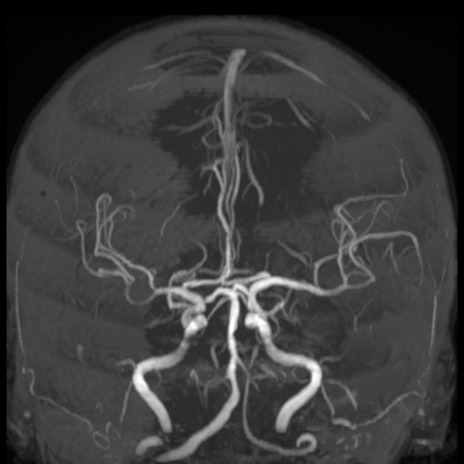【頭部】症例59 MRI（MRA MIP像）4日後