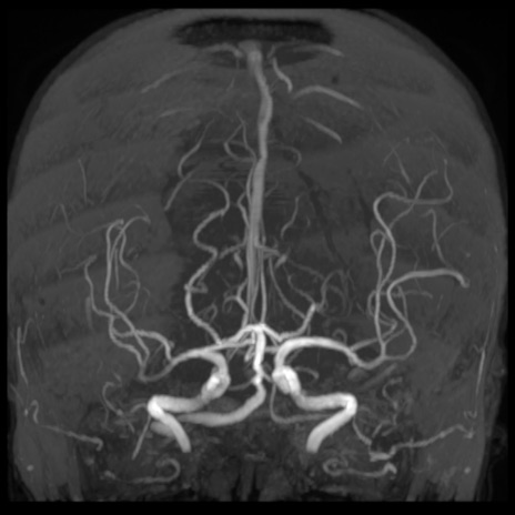 【頭部】症例59 MRI（MRA MIP像）4日後