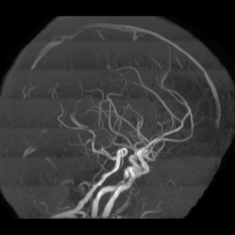 【頭部】症例59 MRI（MRA MIP像）4日後