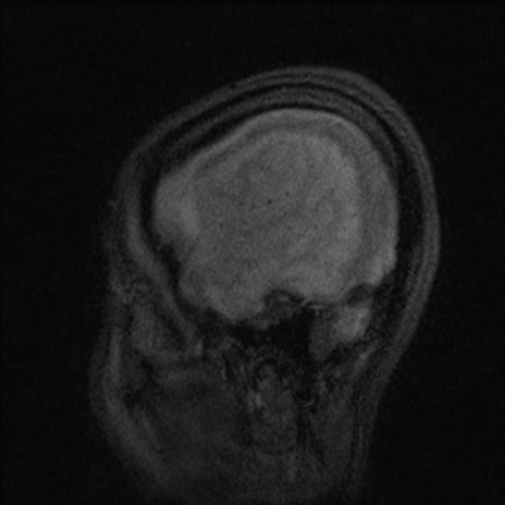 【新頭部】症例25 phase contrast MR venography