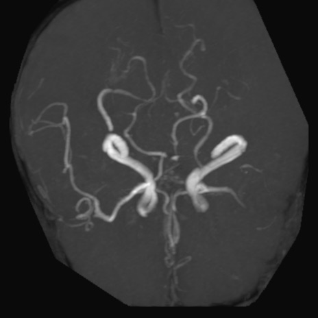【新頭部】症例18 MRA MIP像