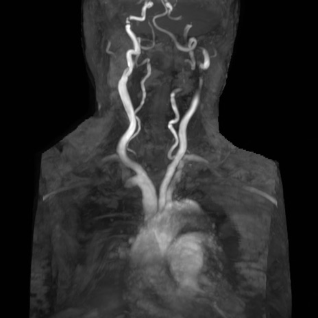 【新頭部】症例26 MRA MIP像