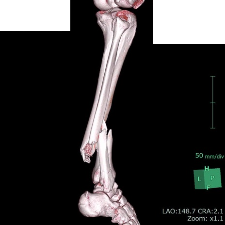 症例29 3D再構成
