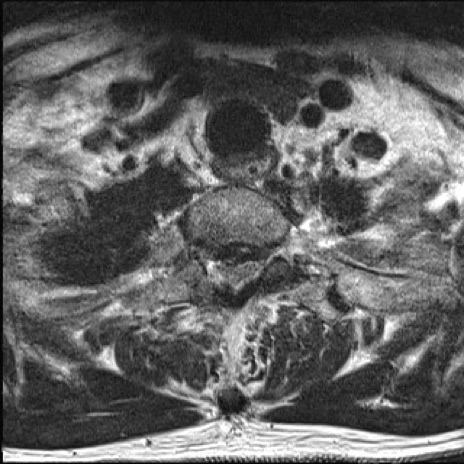 【整形】TIPS症例8 頚椎MRI T2WI(横断像)