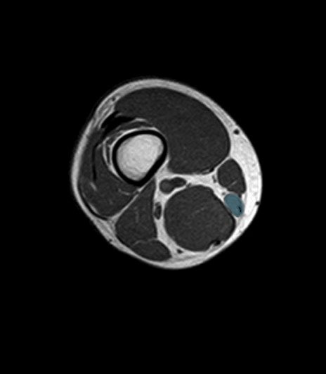 薄筋(gracilis muscle)のMRI画像の解剖