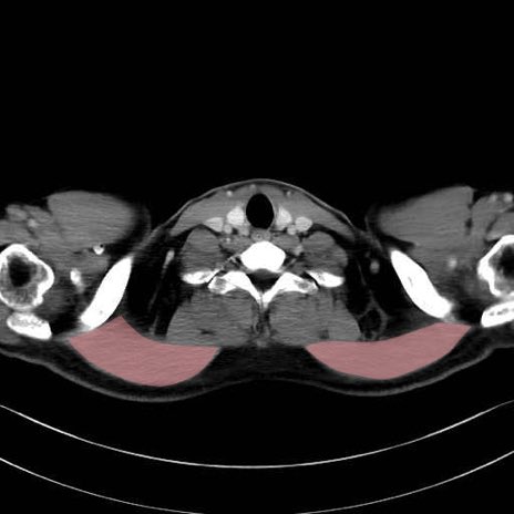 僧帽筋(trapezius)のCT画像の解剖