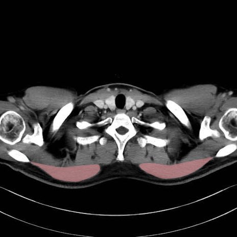 僧帽筋(trapezius)のCT画像の解剖