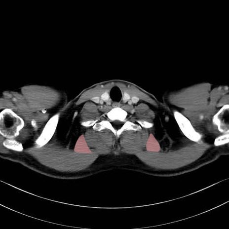 肩甲挙筋(levator scapulae muscle)のCT画像の解剖