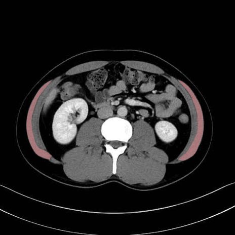外腹斜筋(abdominal external oblique muscle)のCT画像の解剖